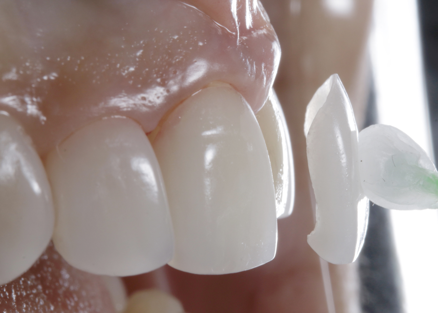 ⭐️ Carillas dentales en Las Palmas | Clinica Valderrama